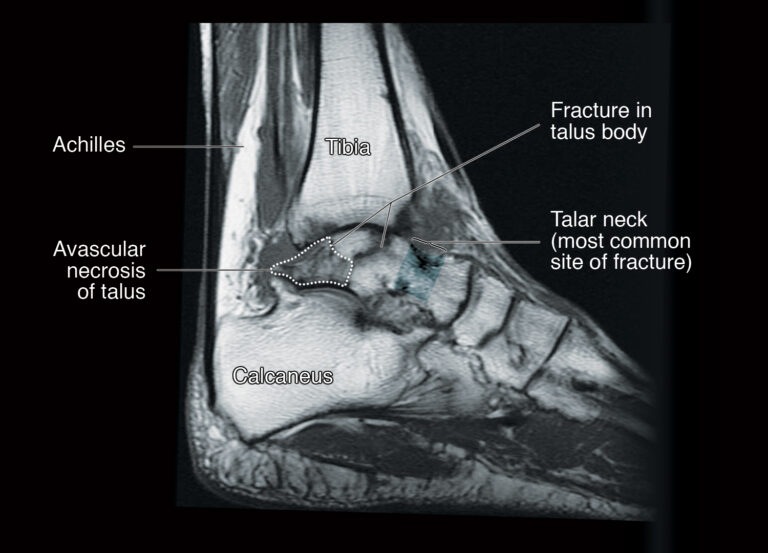 Avascular Necrosis of the Talus | Dr Bijan 4 Feet