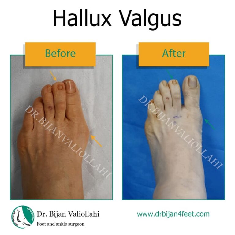 Bunion Deformity (Hallux Valgus) | Dr Bijan 4 Feet
