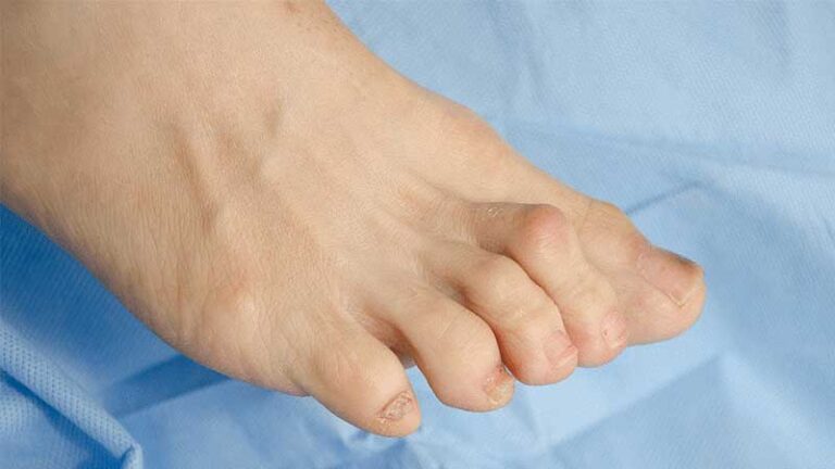 Claw Toe | Dr Bijan 4 Feet