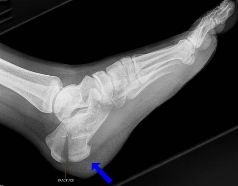 Fractures of the Heel Bone | Dr Bijan 4 Feet
