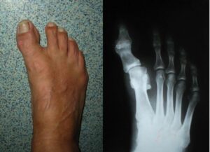 Hallux Varus | Dr Bijan 4 Feet