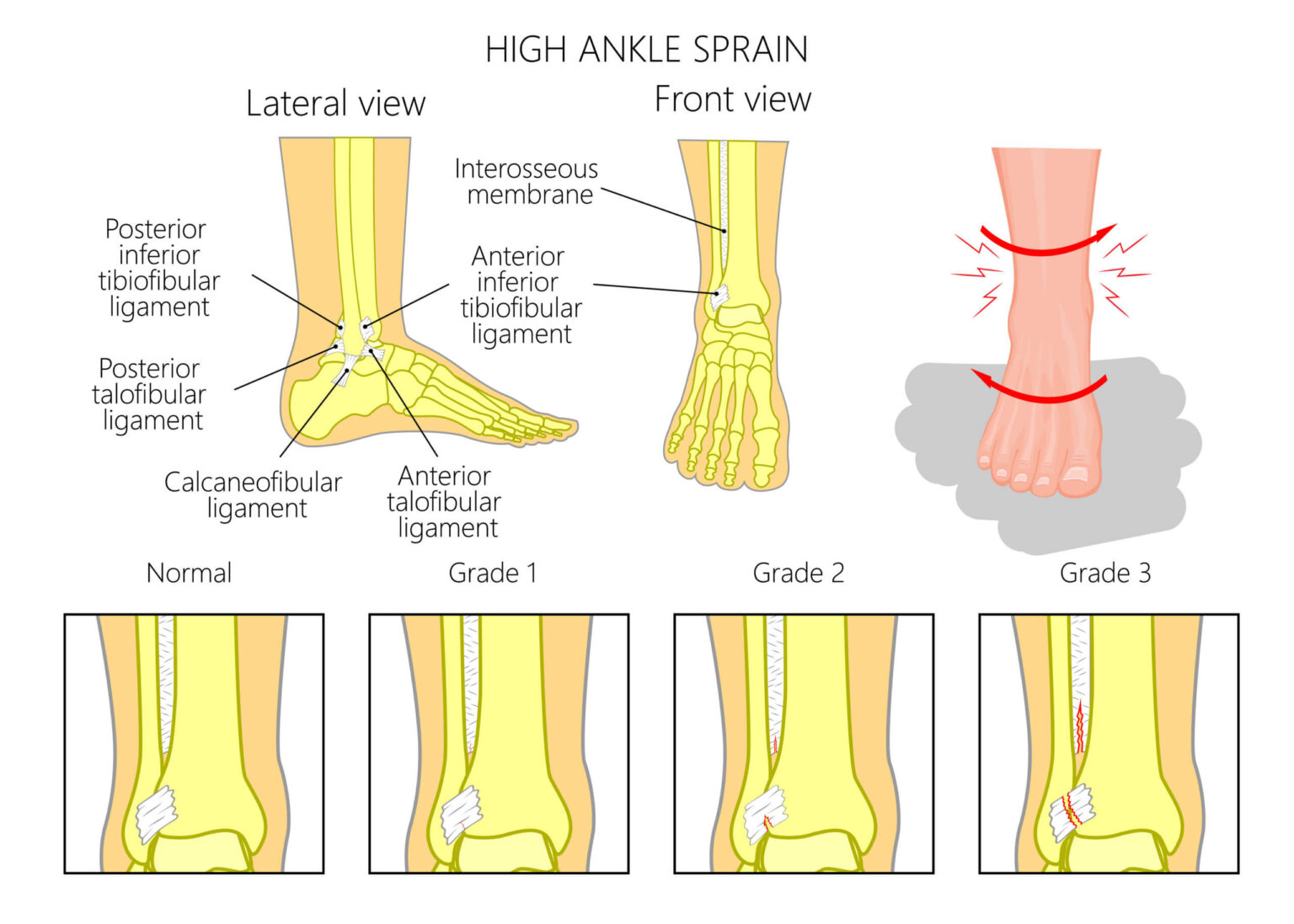 High Ankle Sprains | Dr Bijan 4 Feet