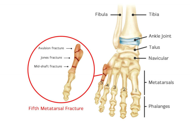 Metatarsal Fracture | Dr Bijan 4 Feet