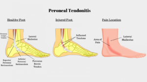 Peroneal Tendon Injury | Dr Bijan 4 Feet