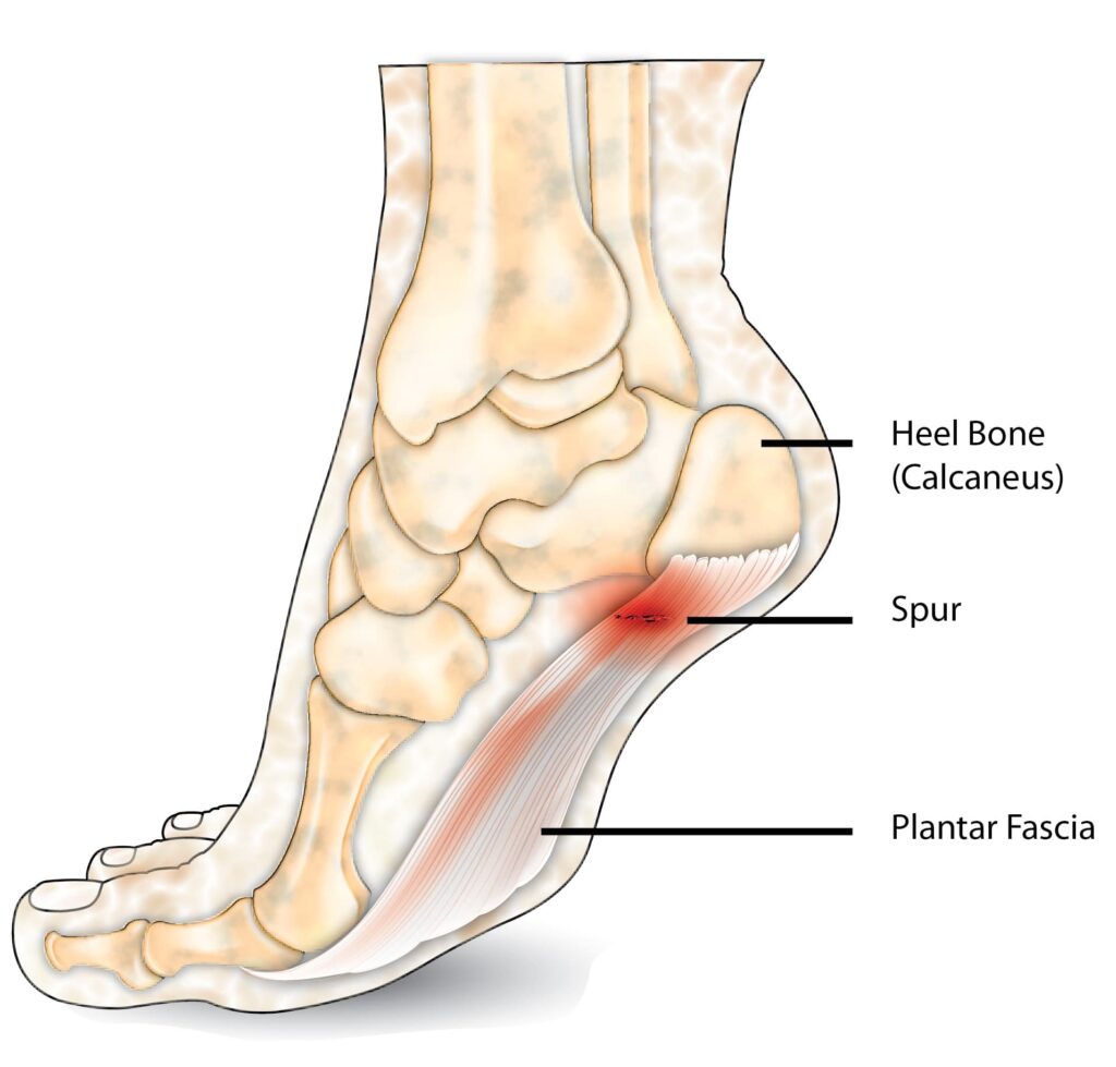 Posterior Heel Spur | Dr Bijan 4 Feet