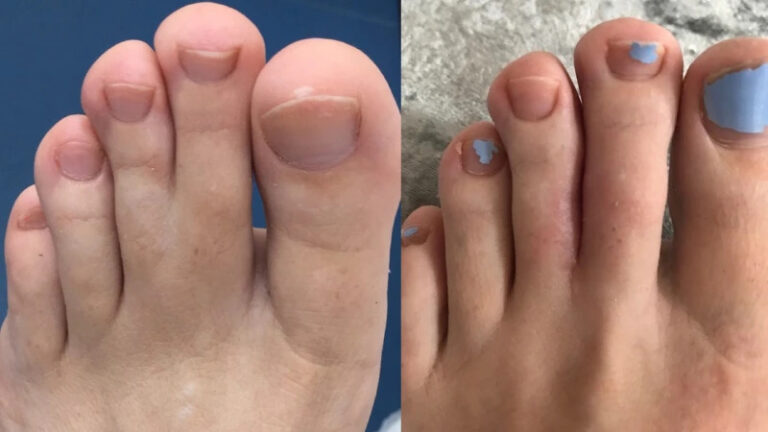 Cosmetic Foot Surgery Dubai | Dubai Cosmetic Surgery Clinic