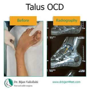 Talus Ocd | Dr Bijan 4 Feet
